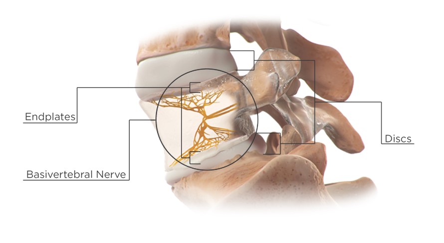 Back Neck Center Of Excellence | Intracept | Optim Health System | Georgia