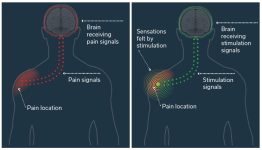 SPRINT PNS System - OPTIM Health System