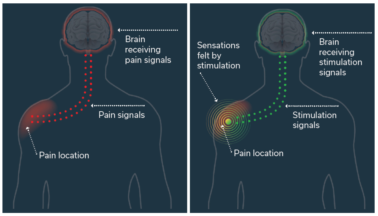 SPRINT PNS System - OPTIM Health System