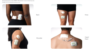 SPRINT PNS System - OPTIM Health System