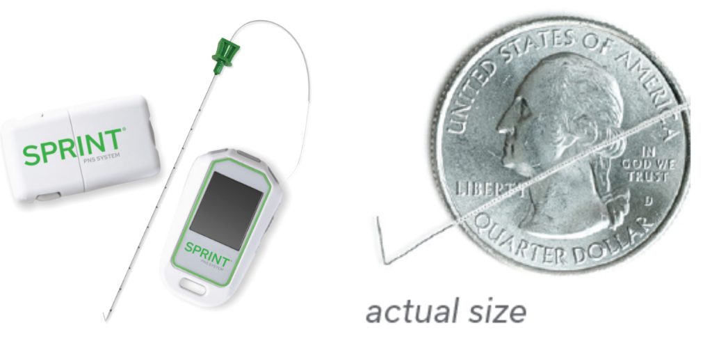 SPRINT PNS System - OPTIM Health System