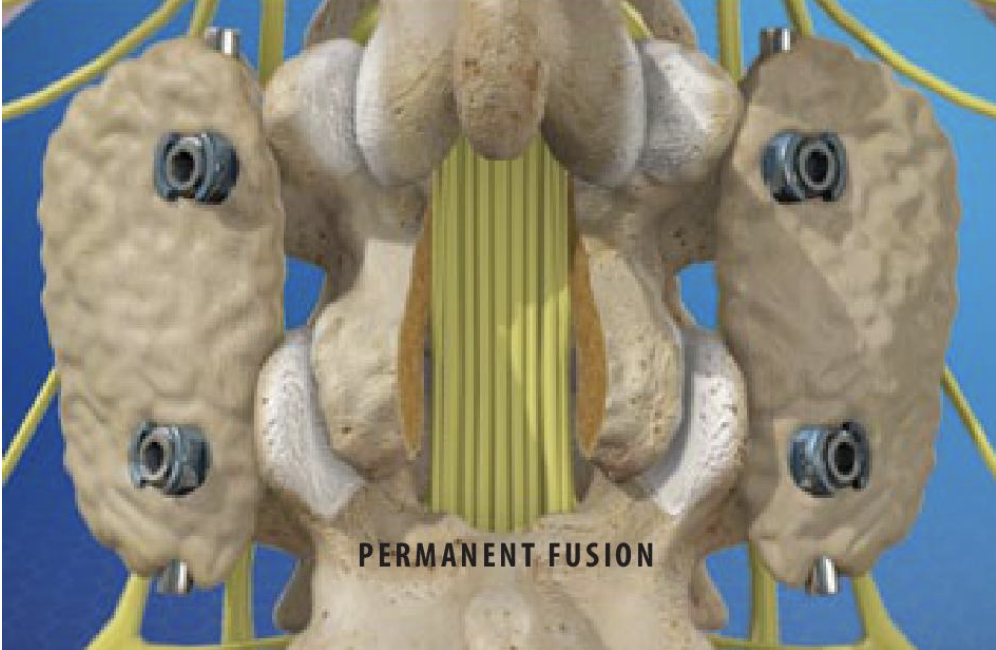 Spinal Fusion for Cervical, Thoracic, and Lumbar Trauma - OPTIM Health ...
